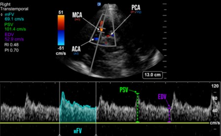 Transcranial Doppler in the Emergency Department: A Clinical ...