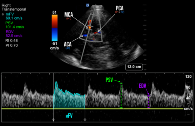 Transcranial Doppler in the Emergency Department: A Clinical Application and Quick Reference ...