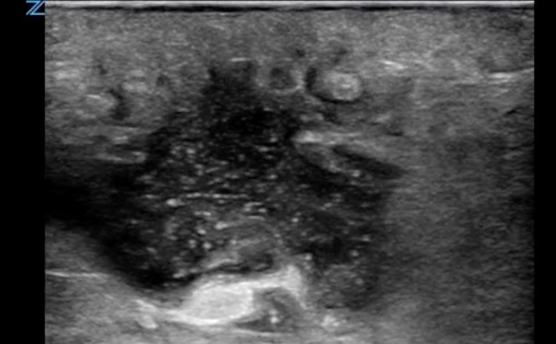 Abscess Evaluation | Sonoguide