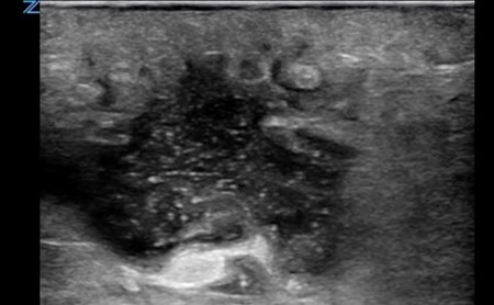 Abscess Evaluation | Sonoguide