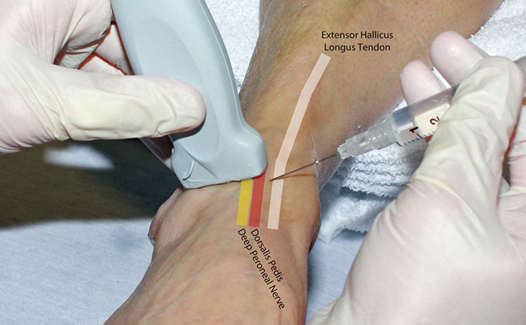 Deep Peroneal Nerve Block Sonoguide 0596