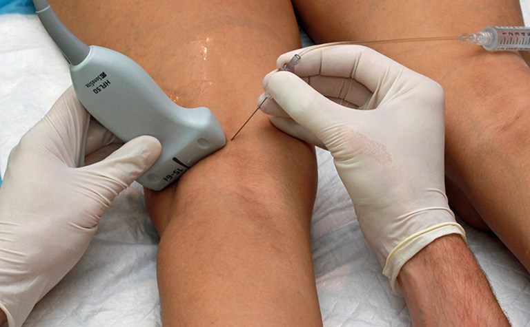 Popliteal Sciatic Nerve Block | Sonoguide