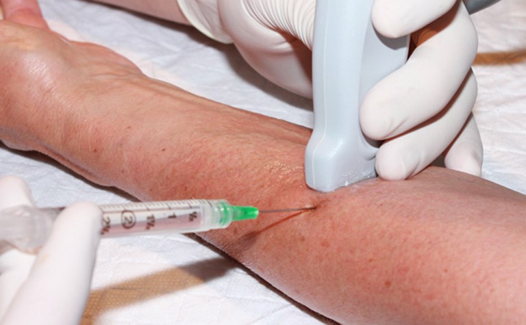 Radial Nerve Block | Sonoguide