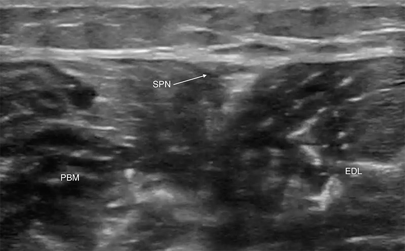 Superficial Peroneal Nerve Block | Sonoguide
