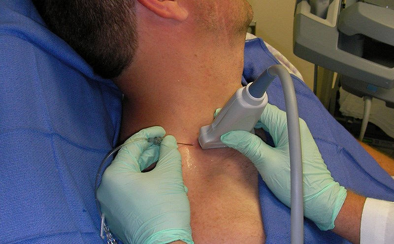 Supraclavicular Brachial Plexus Block | Sonoguide