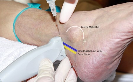 Sural Nerve Block | Sonoguide