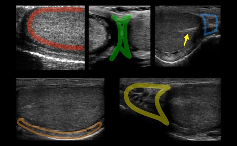 Small Parts - Testicular Ultrasound | Sonoguide