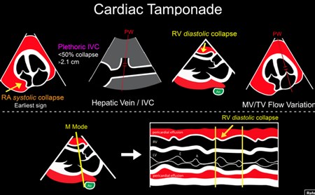 Cardiac Tamponade | EM Ultrasound Section