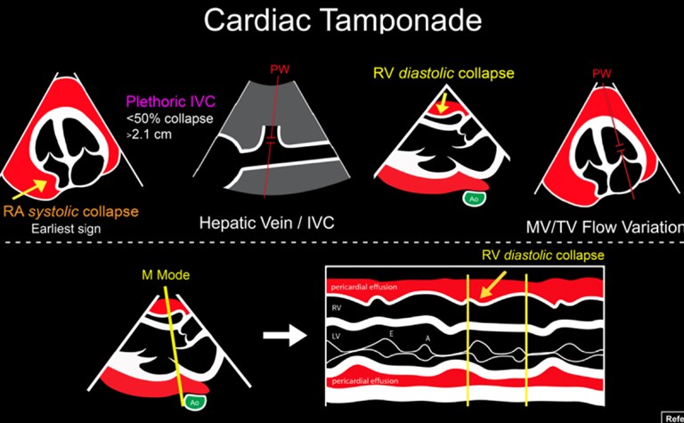 Cardiac Tamponade | EM Ultrasound Section