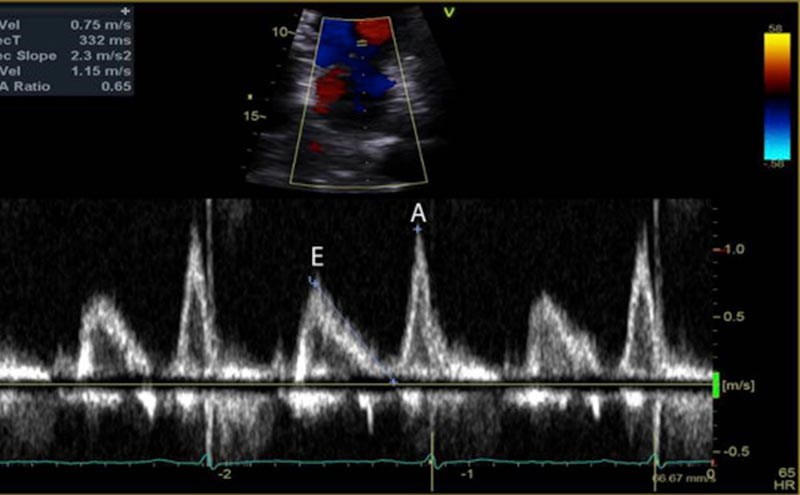 Fellows’ Section: Diastology at the Bedside | EM Ultrasound Section