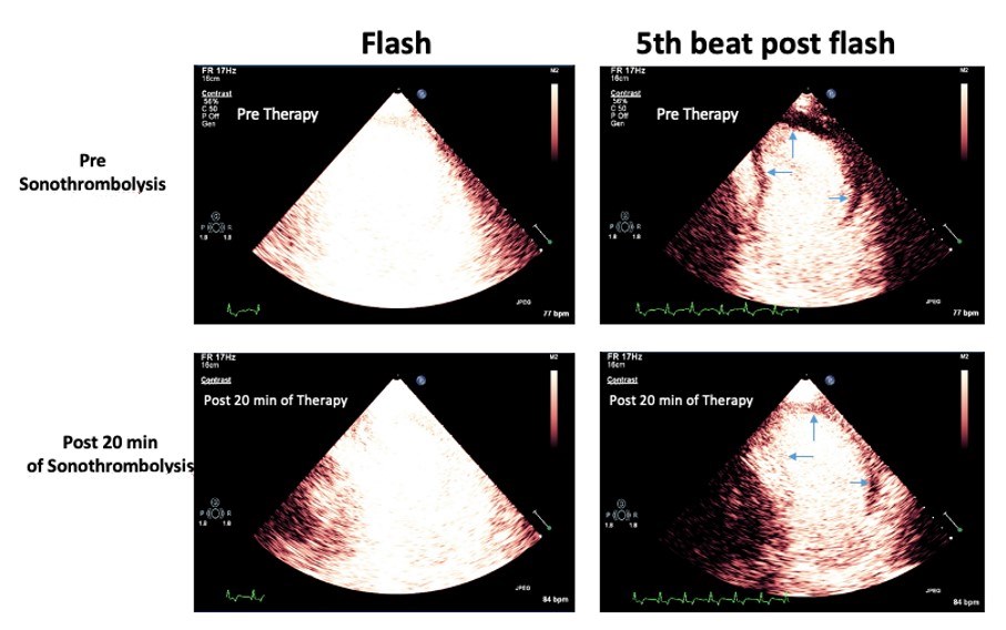 Emerging Ultrasound Technology: Sonothrombolysis in the treatment of ...