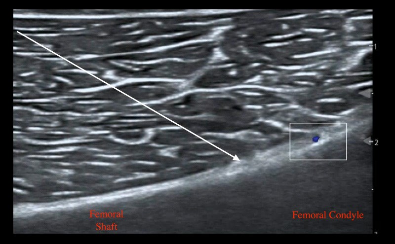The Genicular Nerve Block for Knee Pain in the Emergency Department ...