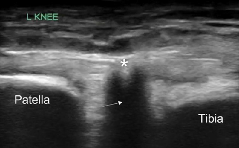 Diagnosis of Tibial Tubercle Fracture on Point-of-Care-Ultrasound | EM ...