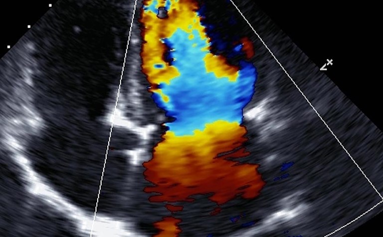 Venous Doppler and IV Fluid Administration | EM Ultrasound Section