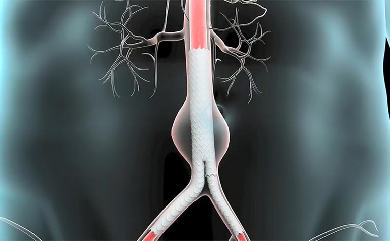 Ruptured Abdominal Aortic Aneurysm | EM Ultrasound Section