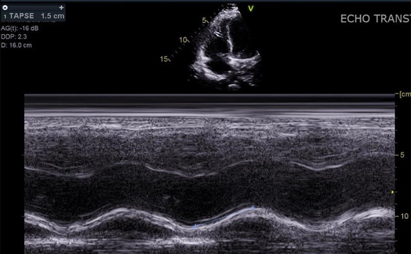 RV Strain | EM Ultrasound Section
